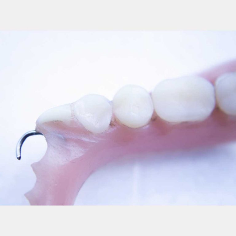 Partial Dentures Calgary | Swiss Denture
